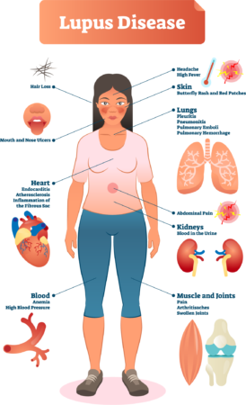 How Lupus Is Influenced by Gut Health